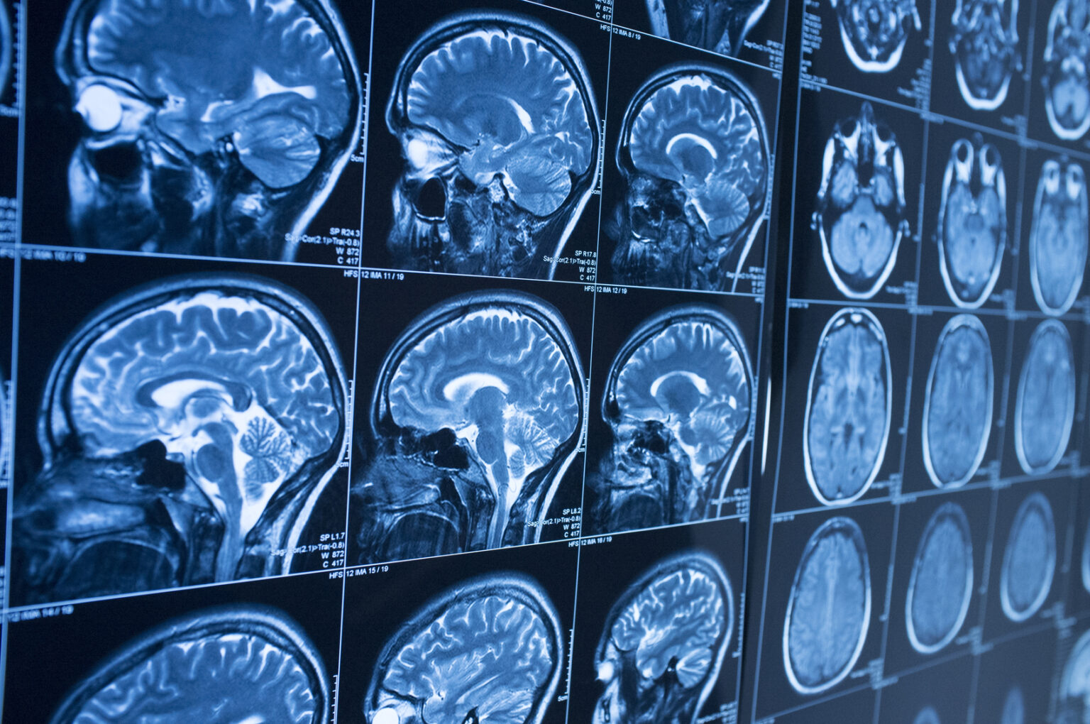 Port St. Lucie Brain Injury Lawyer | Graves Thomas Injury Law Group